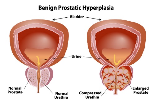 New Treatment Improves Enlarged Prostate Symptoms Lexington Medical Center Blog Lexwell